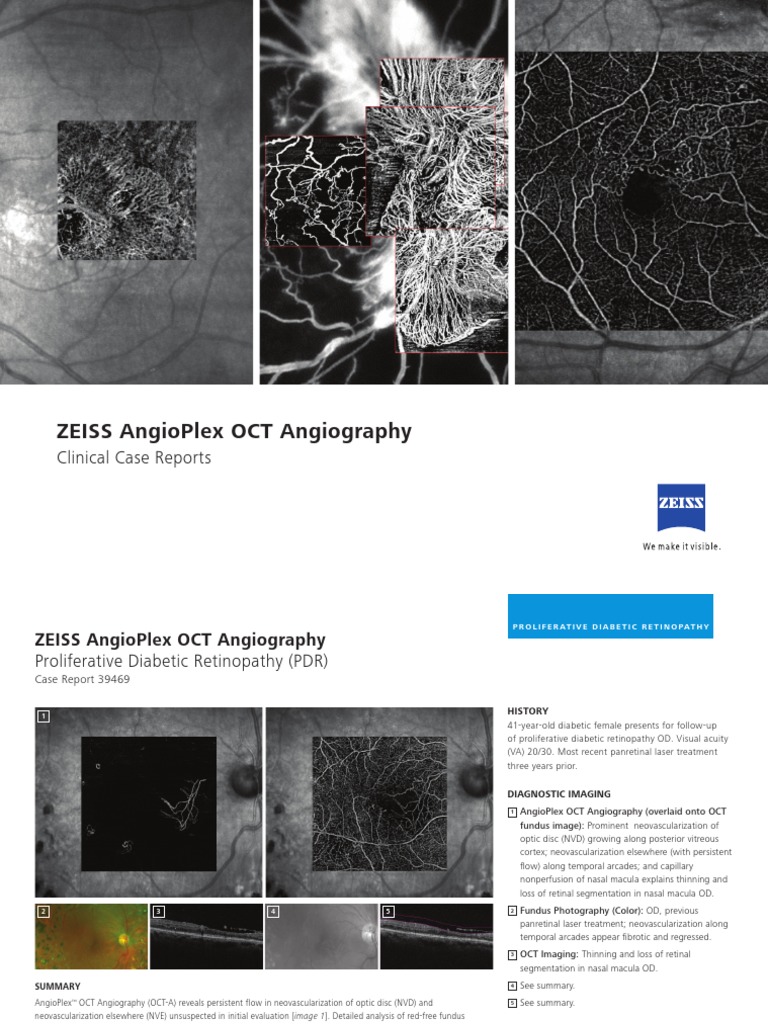 ZEISS AngioPlex Case Reports US 31 150 0032I | PDF | Retina | Senses