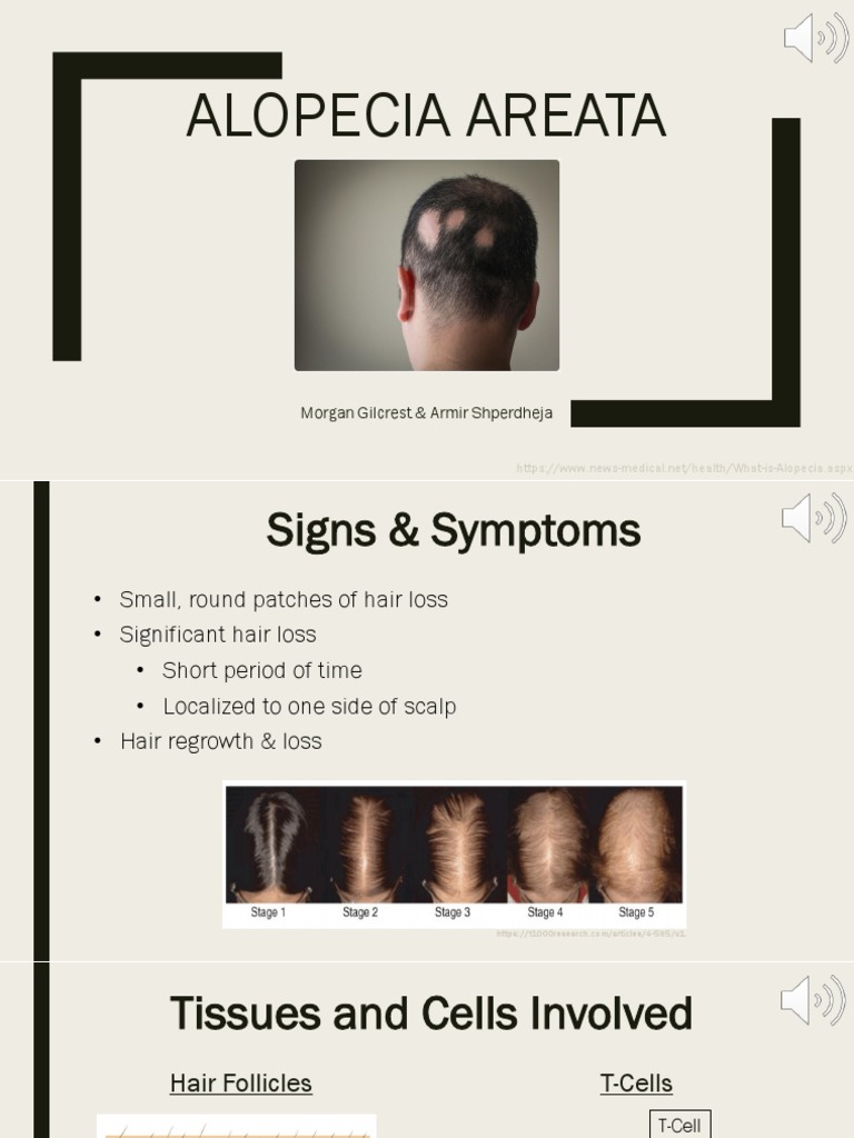 Alopecia Areata: Morgan Gilcrest & Armir Shperdheja | PDF | T Cell ...