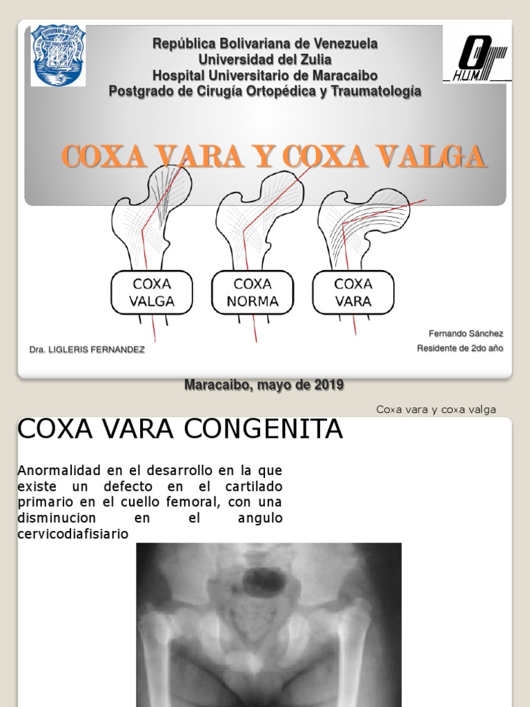 Coxa Vara y Coxa Valga Fernando | PDF | Traumatologia | Sistema musculoesquelético