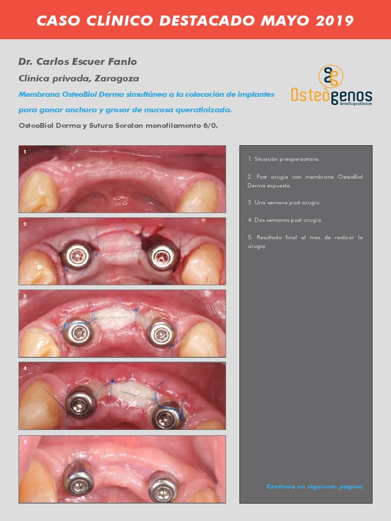 Membrana OsteoBiol Derma Simultánea A La Colocación de Implantespara ...