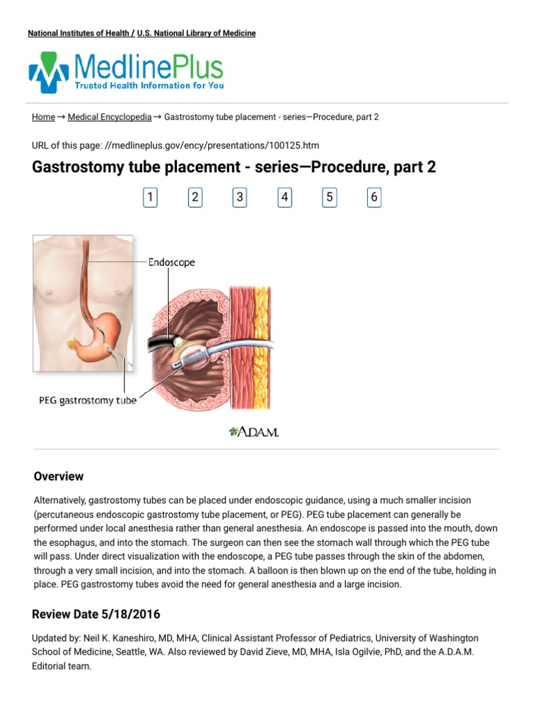 Gastrostomy Tube Placement - Series-Procedure, Part 2 - MedlinePlus ...