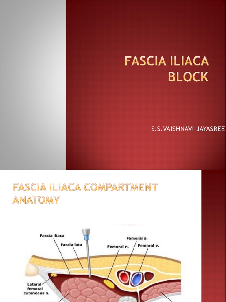 Fascia Iliaca Block Jay | PDF