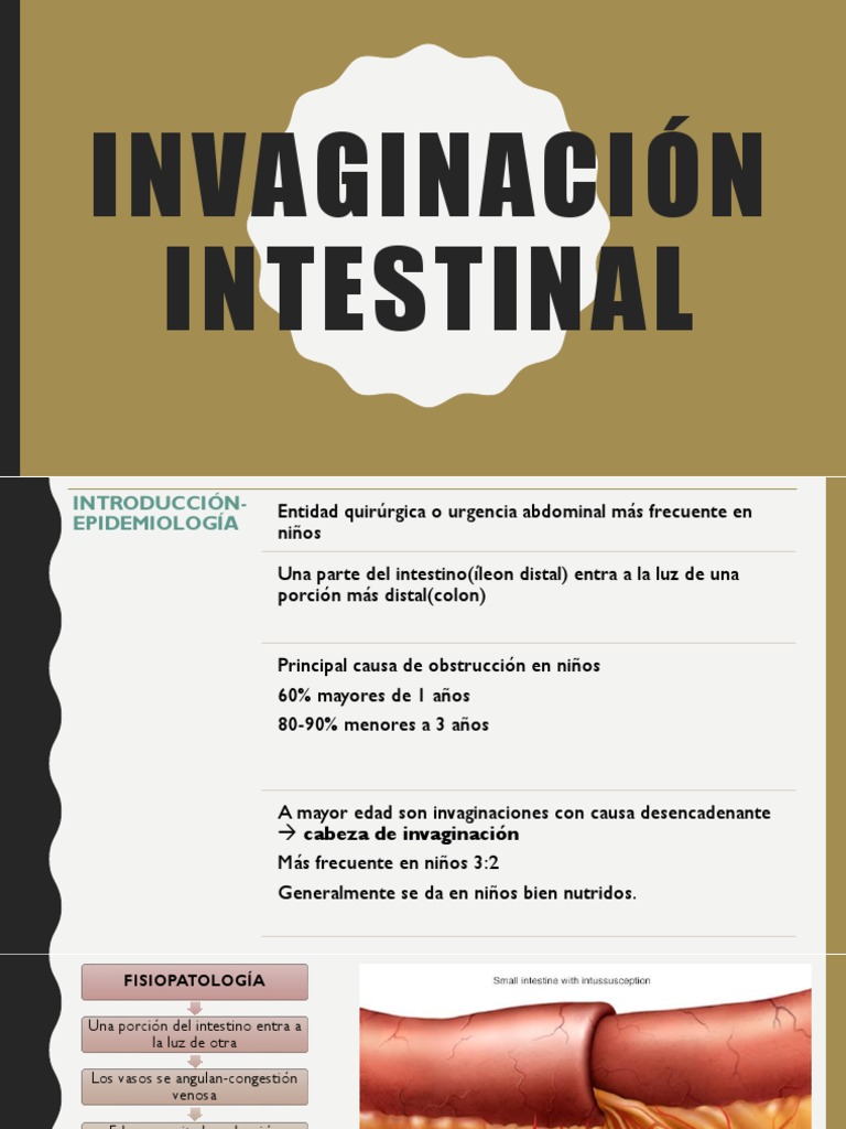 Invaginación Intestinal | PDF | Especialidades Medicas | Medicina CLINICA
