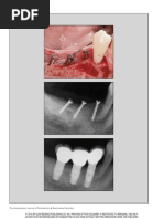 Miller Classification of Marginal Tissue | PDF | Periodontology ...