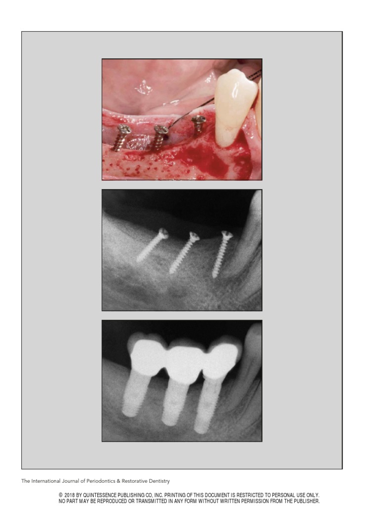 The International Journal of Periodontics & Restorative Dentistry | PDF ...