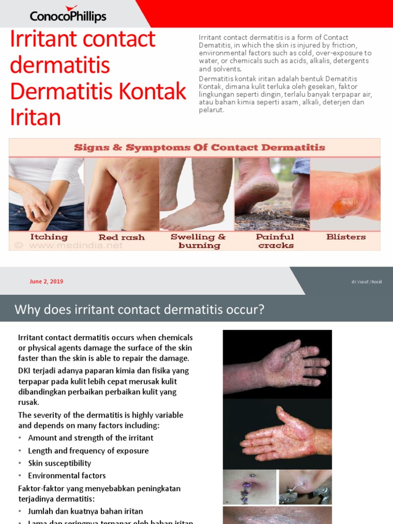 Understanding Irritant Contact Dermatitis | PDF | Dermatitis ...