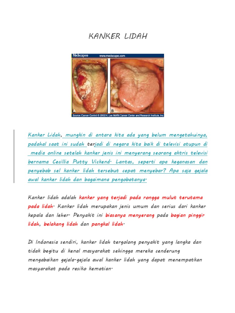 Kanker Lidah: Gejala, Penyebab, dan Pengobatan | PDF | Pengembangan ...