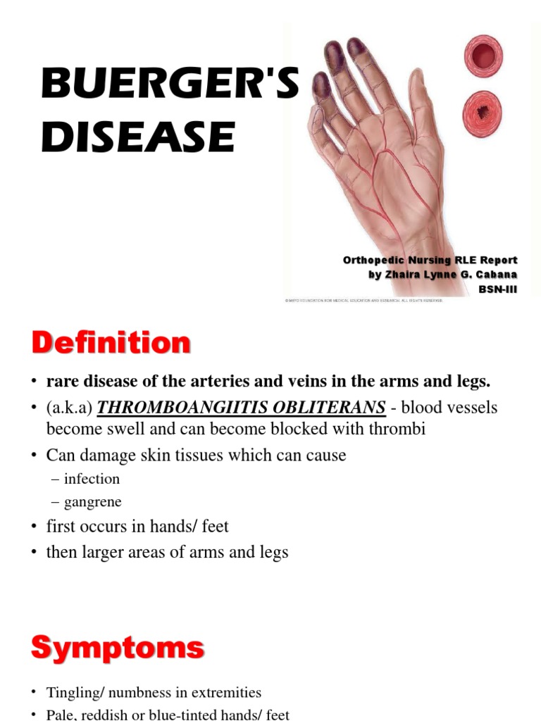 Buerger'S Disease: Orthopedic Nursing RLE Report by Zhaira Lynne G ...
