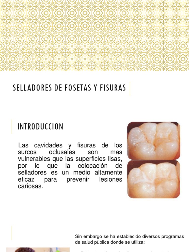 Selladores de Fosetas y Fisuras Dentales | PDF | Naturaleza | Salud y ...