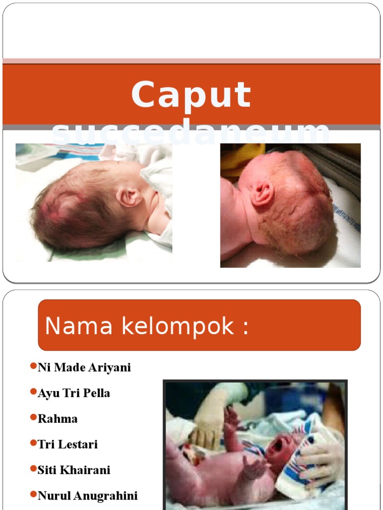 Caput Succedaneum | PDF