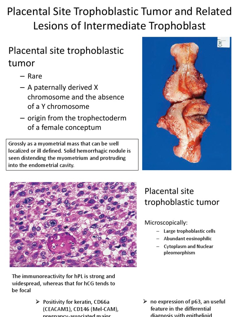 Placental Site Trophoblastic Tumor and Related Lesions of Intermediate ...