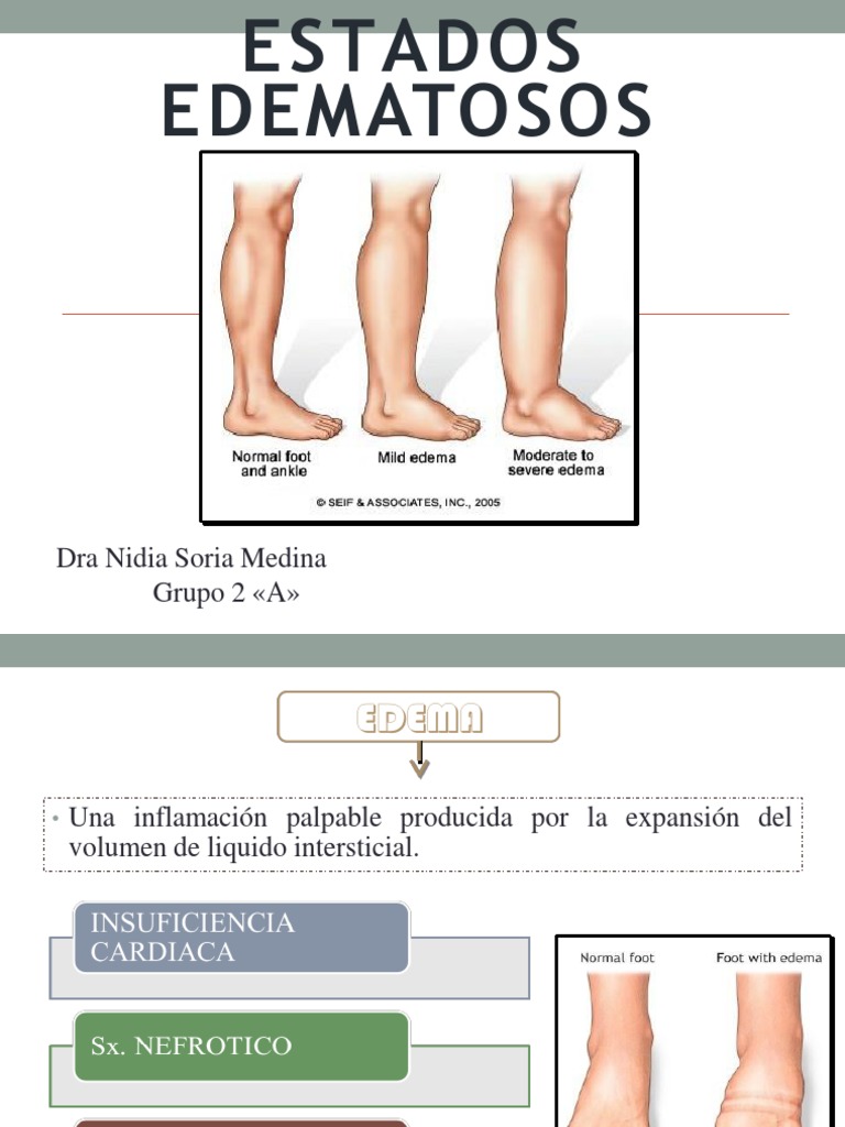 Exposicion Estado Edematoso | PDF | Edema | Especialidades Medicas