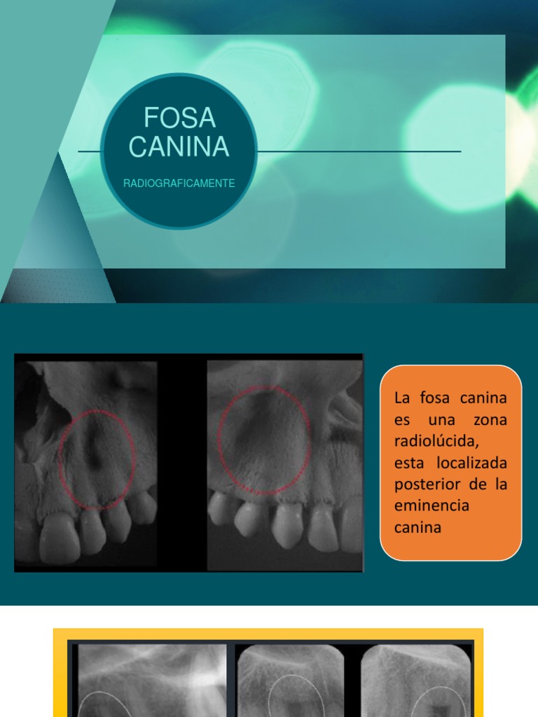 Fosa Canina PDF | PDF