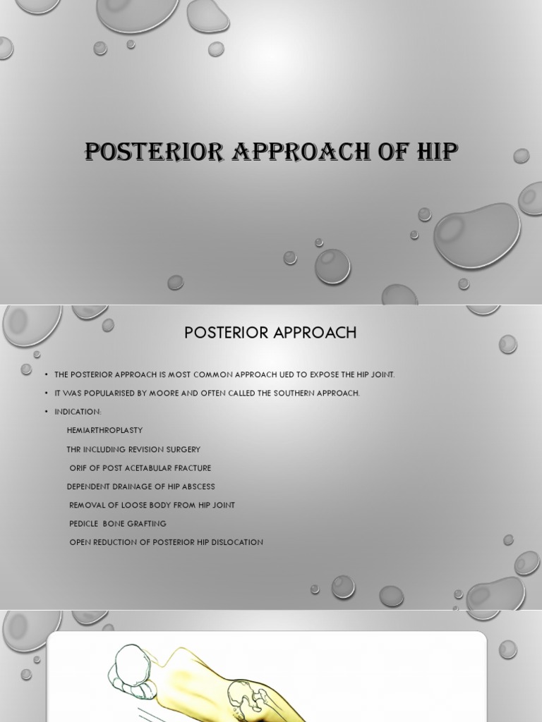 Posterior Approach of Hip | PDF | Hip | Human Anatomy