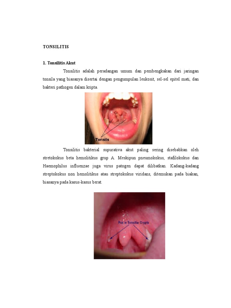 Tonsilitis | PDF