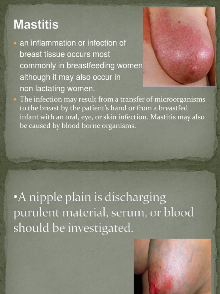 Mastatis | PDF | Breast | Secondary Sexual Characteristics