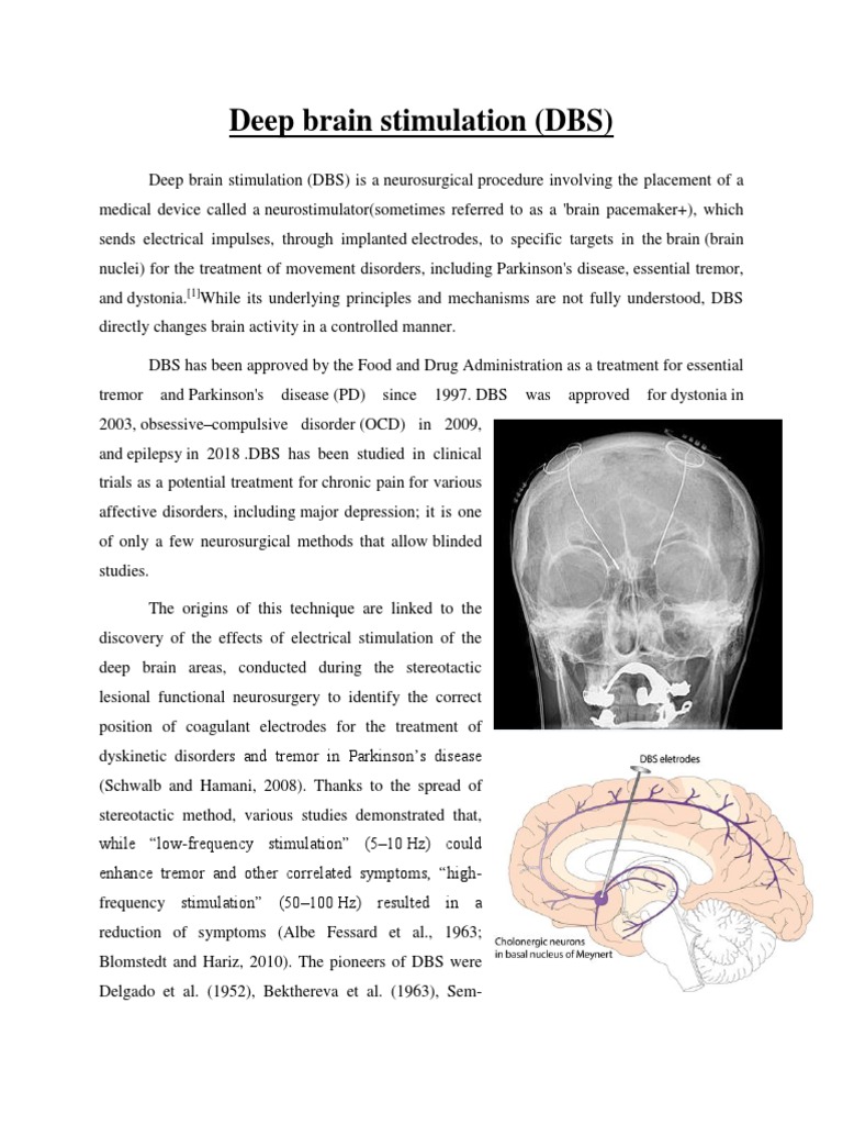 Deep Brain Stimulation for Movement Disorders | PDF | Deep Brain ...