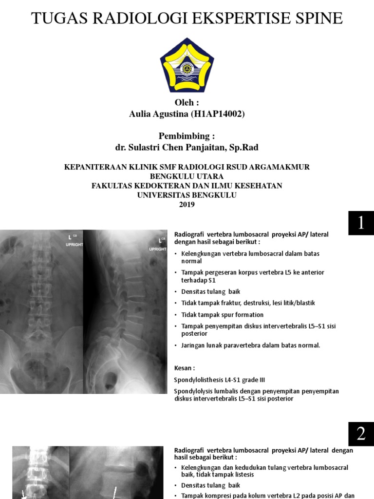 Ekspertise Radiologi Vertebra Lumbosacral | PDF