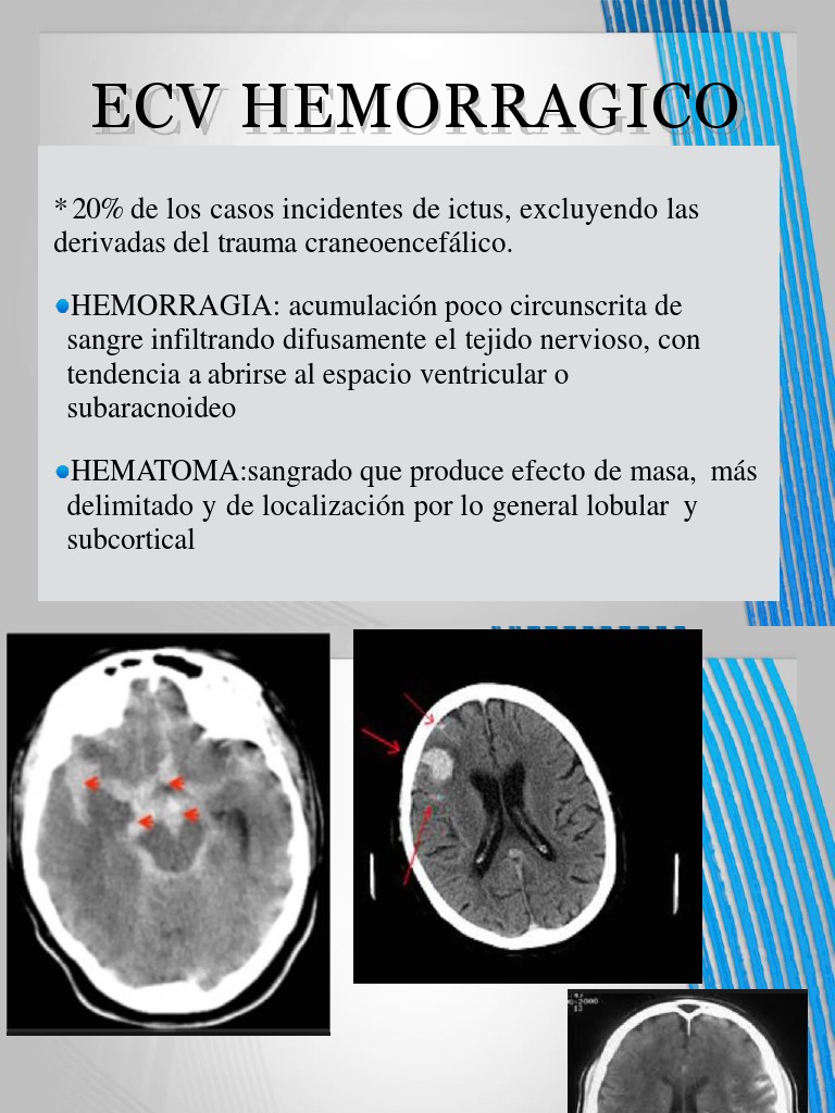 Evc Hemorragico | PDF | Drogas | Medicina