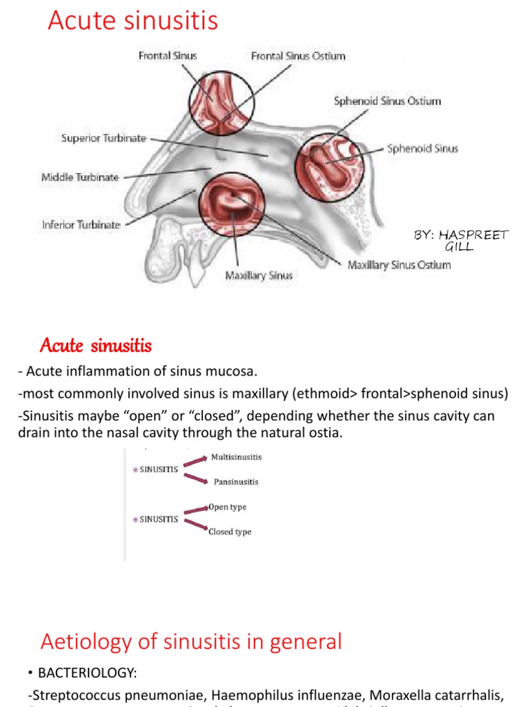 Acute Rhinosinusitis Overview | PDF