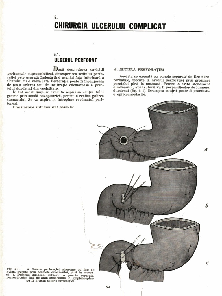 09 Ulcerul Complicat | PDF