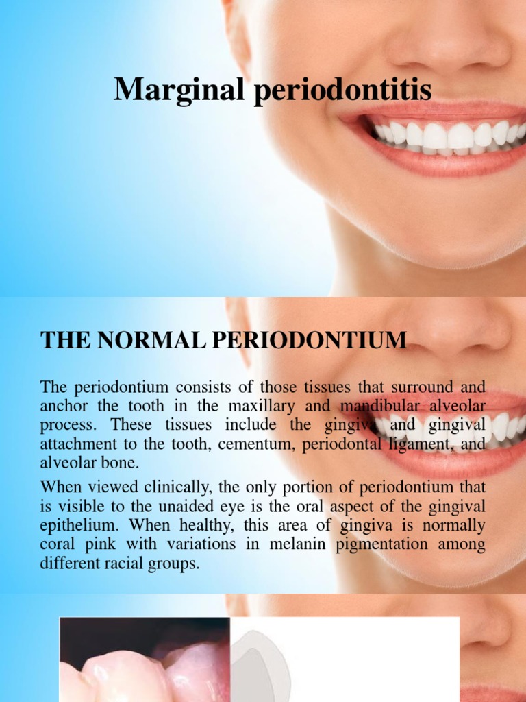 Understanding Marginal Periodontitis | PDF | Human Tooth | Diabetes ...