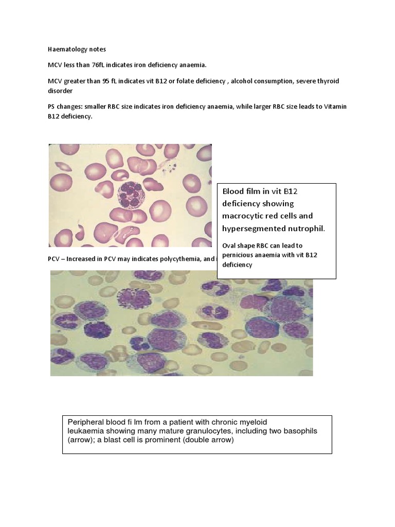 Blood Film in Vit B12 Deficiency Showing Macrocytic Red Cells and ...