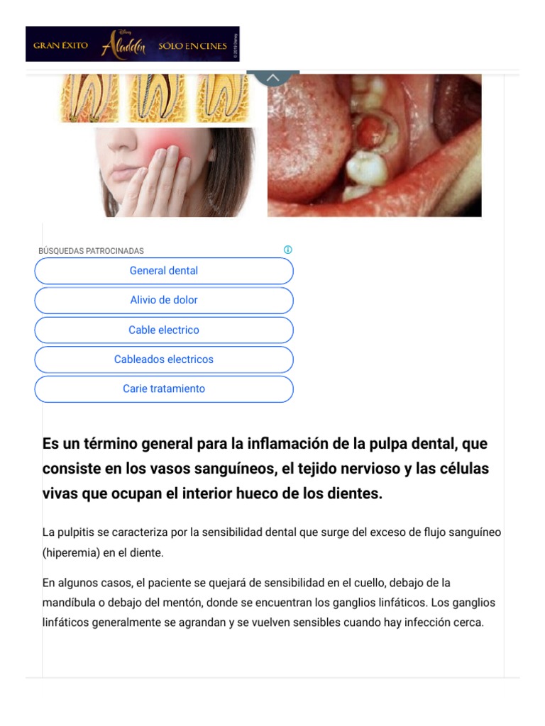 Pulpitis - Reversible e Irreversible - Causas, Síntomas, Diagnóstico y ...