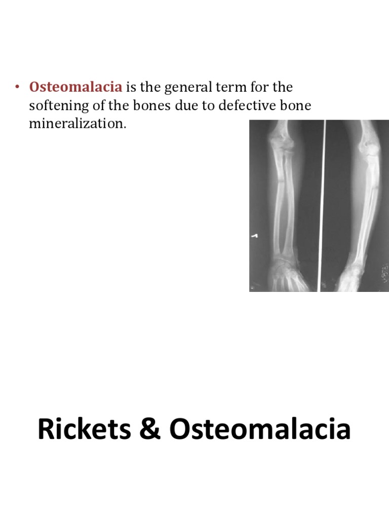 Osteomalacia: Is The General Term For The Softening of The Bones Due To ...