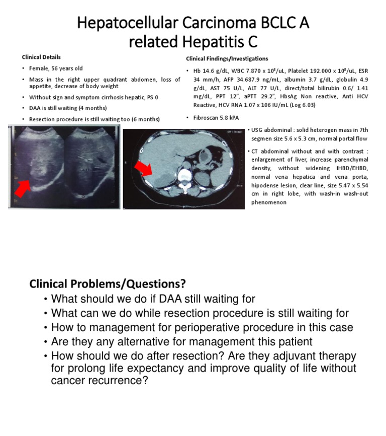 Hepatocellular Carcinoma BCLC A Related Hepatitis C: Clinical Details ...