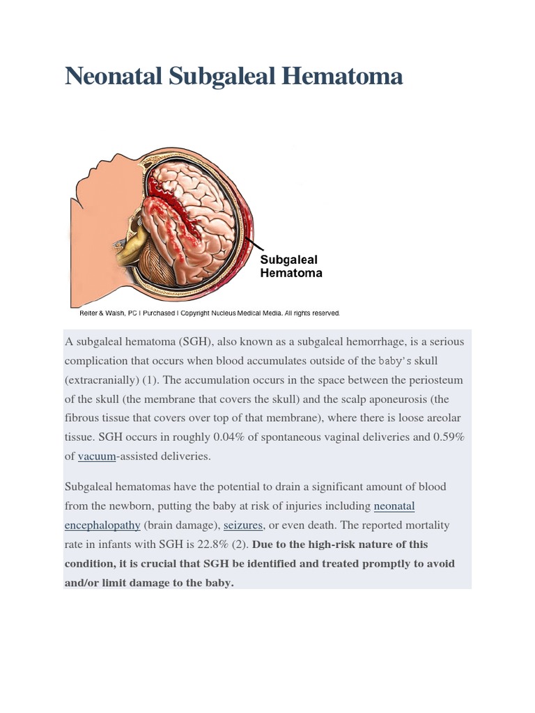 Subgaleal Hematoma In Adults