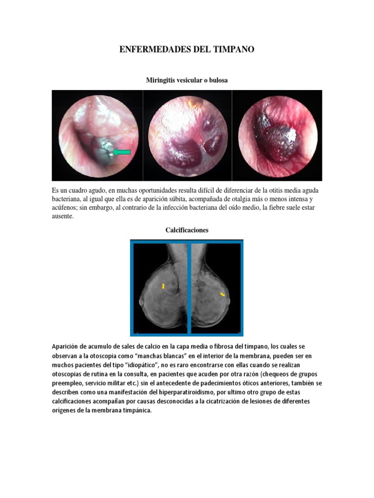 Enfermedades Del Timpano | PDF | Lesión | Las bacterias