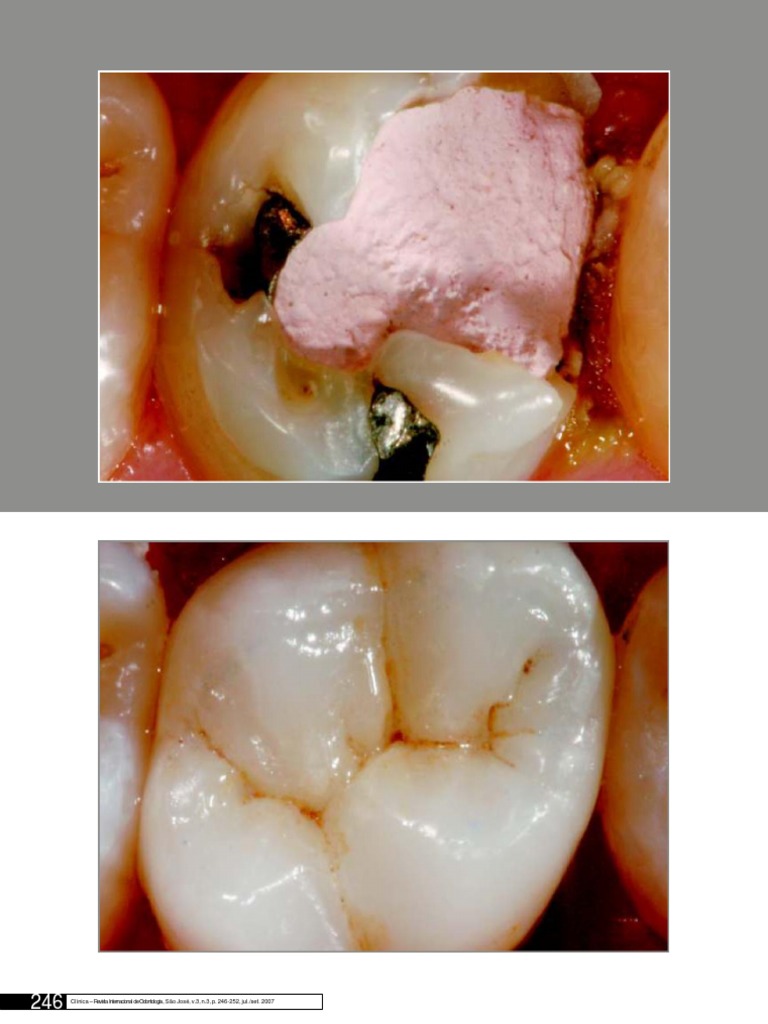 Endocrown Articulo | PDF | Esmalte de dientes | Diente