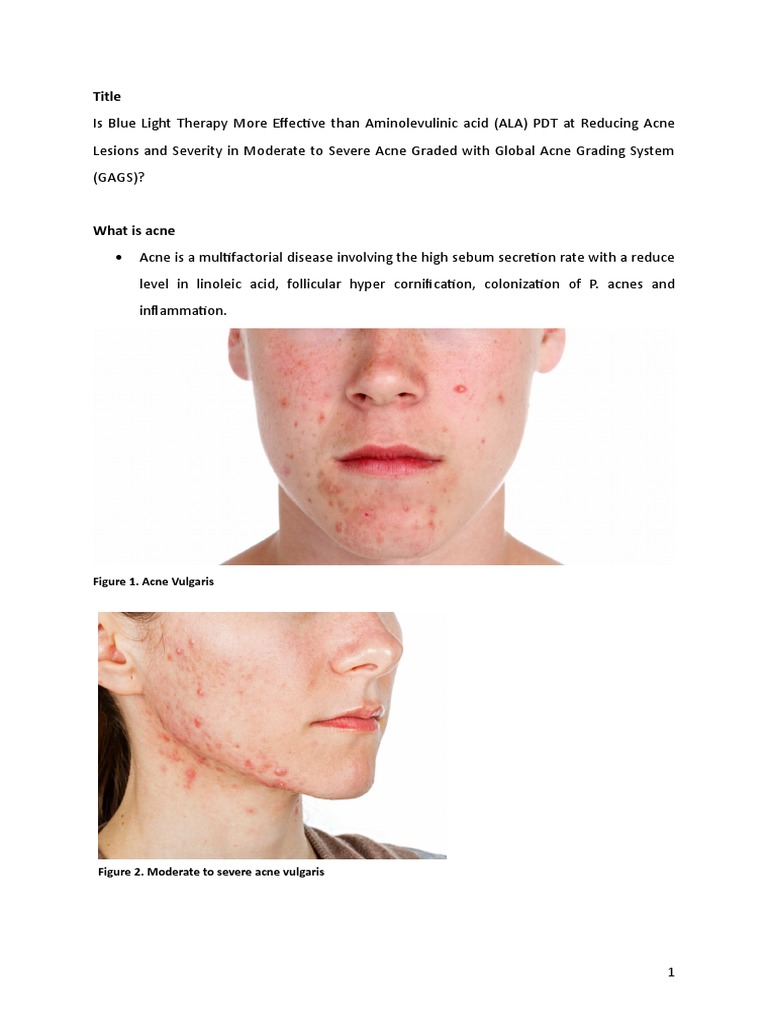 Is Blue Light Therapy More Effective than Aminolevulinic acid (ALA) PDT ...