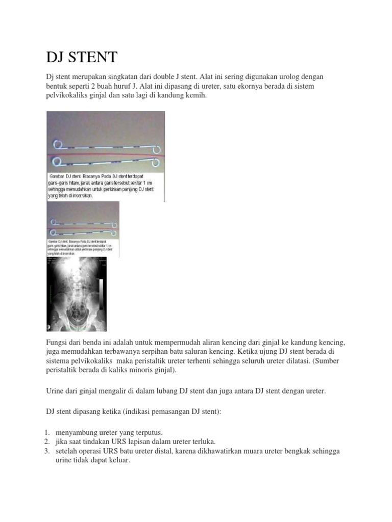 Fungsi dan Risiko DJ Stent Urologi | PDF
