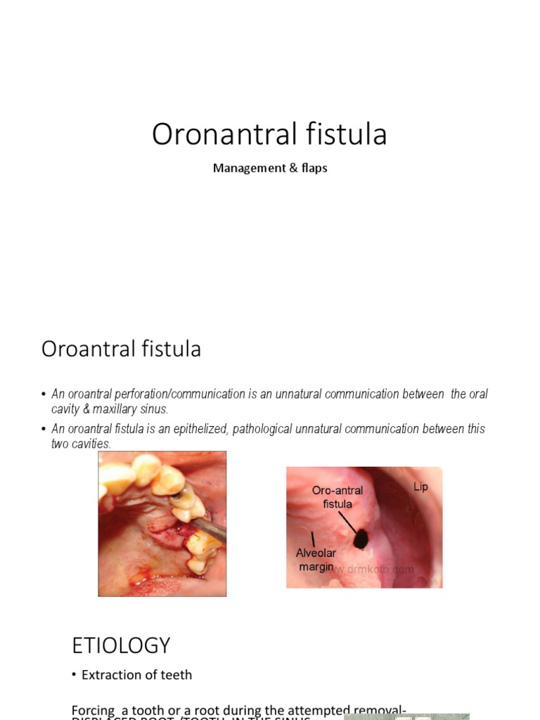Oroantral Fistula | Mouth | Human Head And Neck