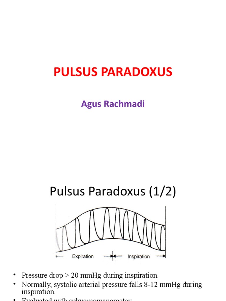 Pulsus Paradoxus | PDF