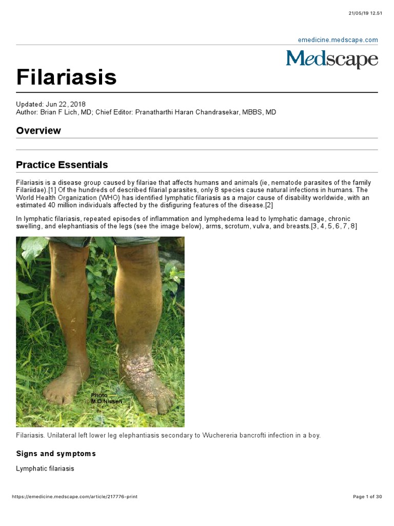 Filariasis: Signs and Symptoms | PDF | Clinical Medicine | Immunology