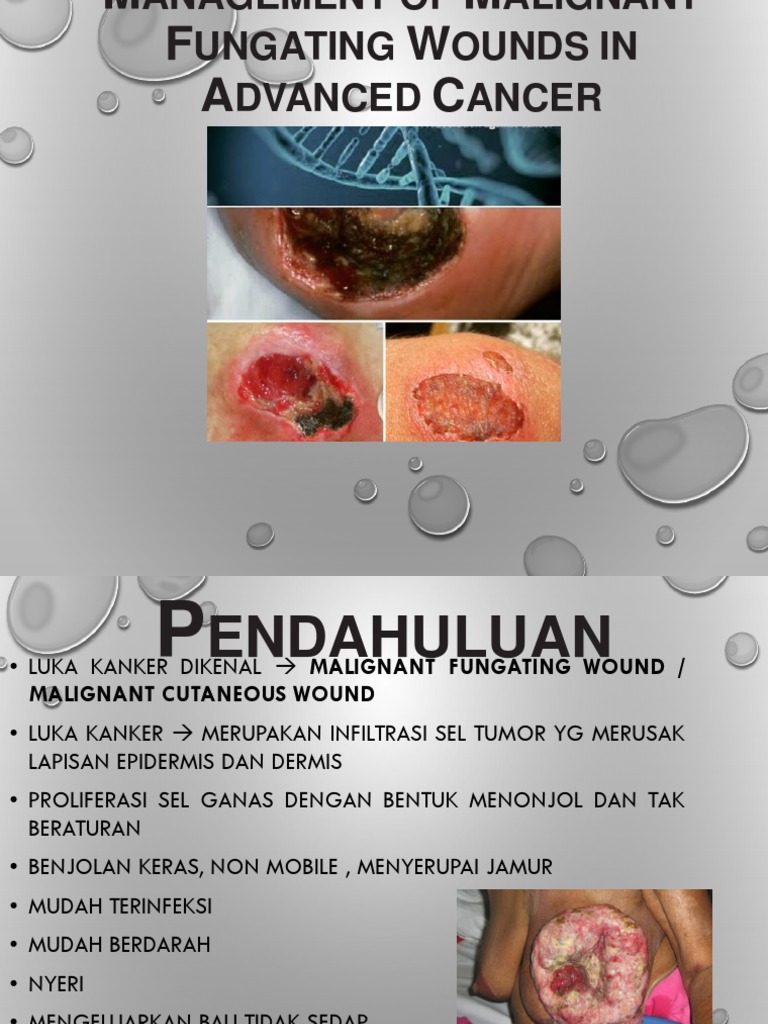 Fix Management of Malignant Fungating Wounds in Advanced Cancer | PDF