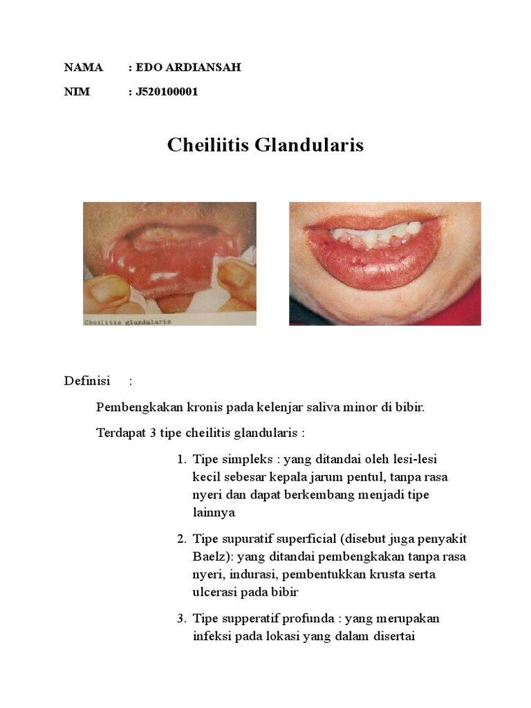 Cheilitis Glandularis