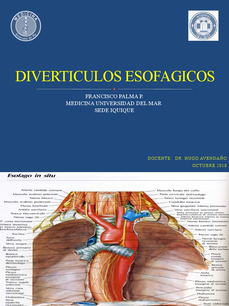 DIVERTICULOS ESOFAGICOS | Enfermedades digestivas | Gastroenterología