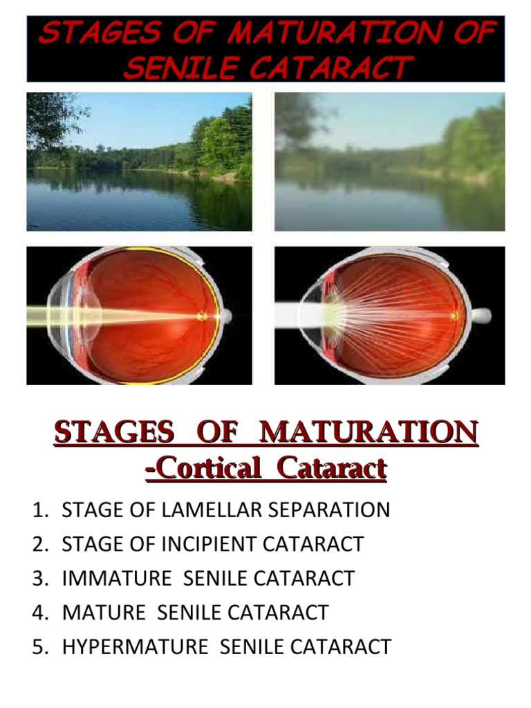 Immature Senile Cataract Iris Shadow