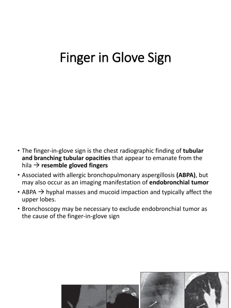 Finger in Glove Sign | PDF