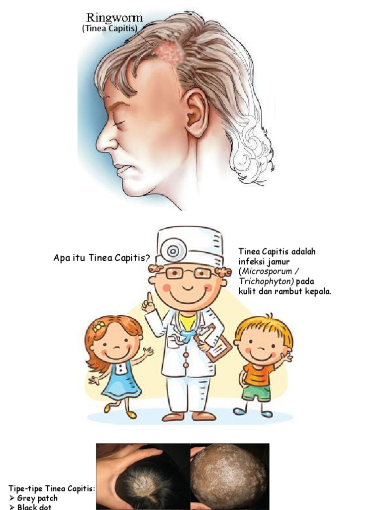 Pengertian Tinea Capitis dan Gejalanya | PDF