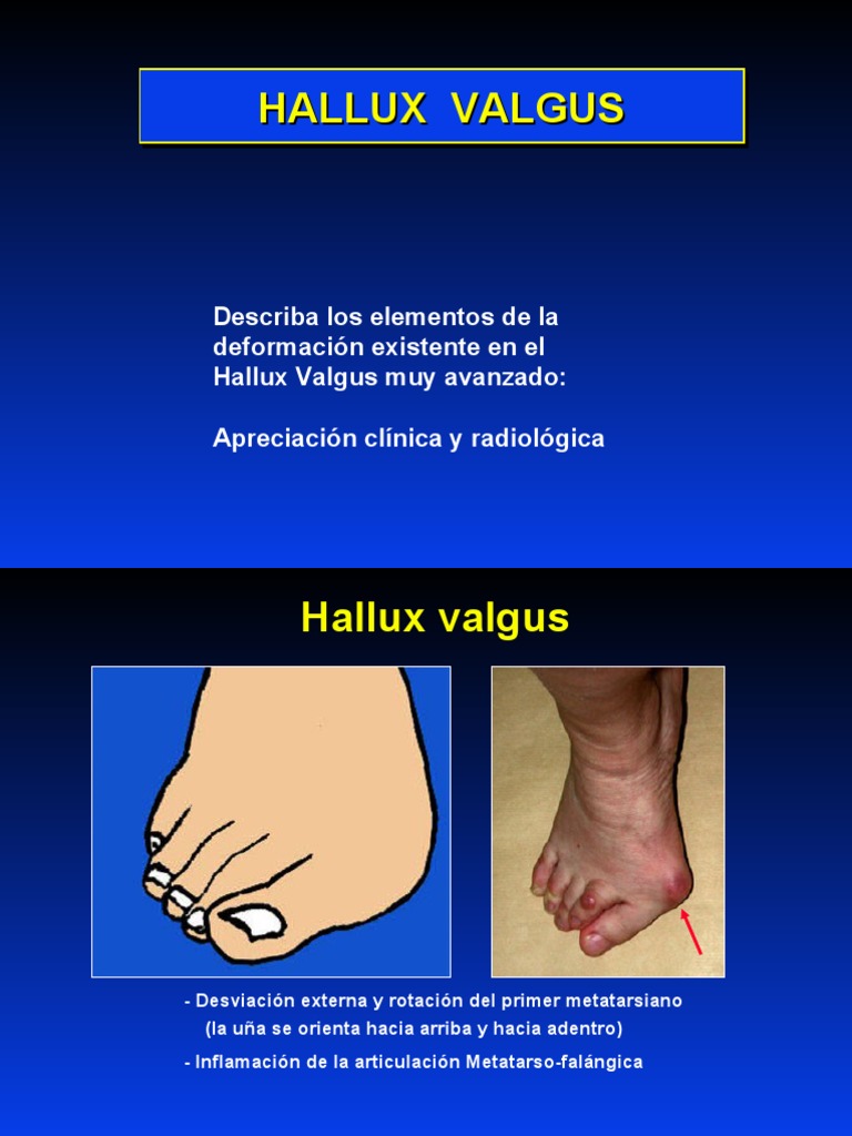 Hallux Valgus | PDF | Dedo del pie | Anatomía del miembro inferior