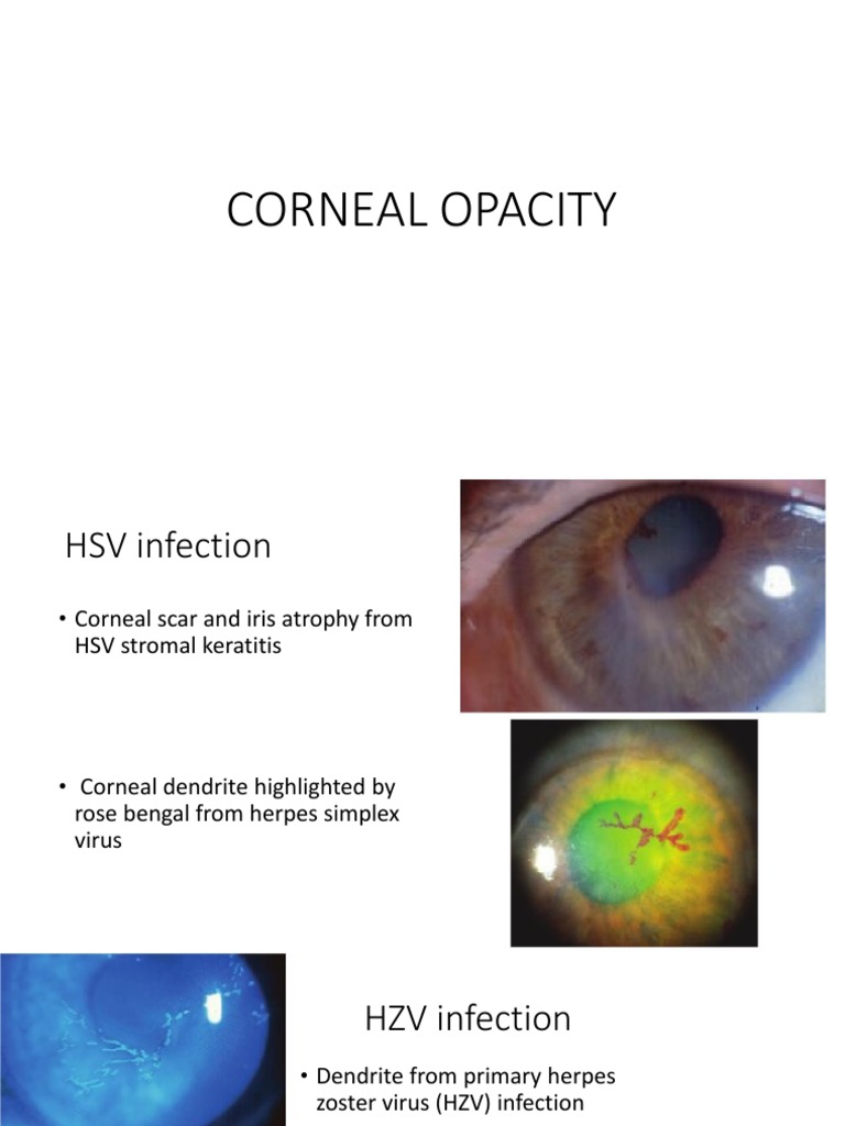 Corneal Opacity and Related Conditions | PDF