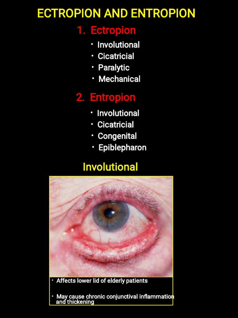 06ectropion & Entropion | PDF | Scar | Diseases And Disorders