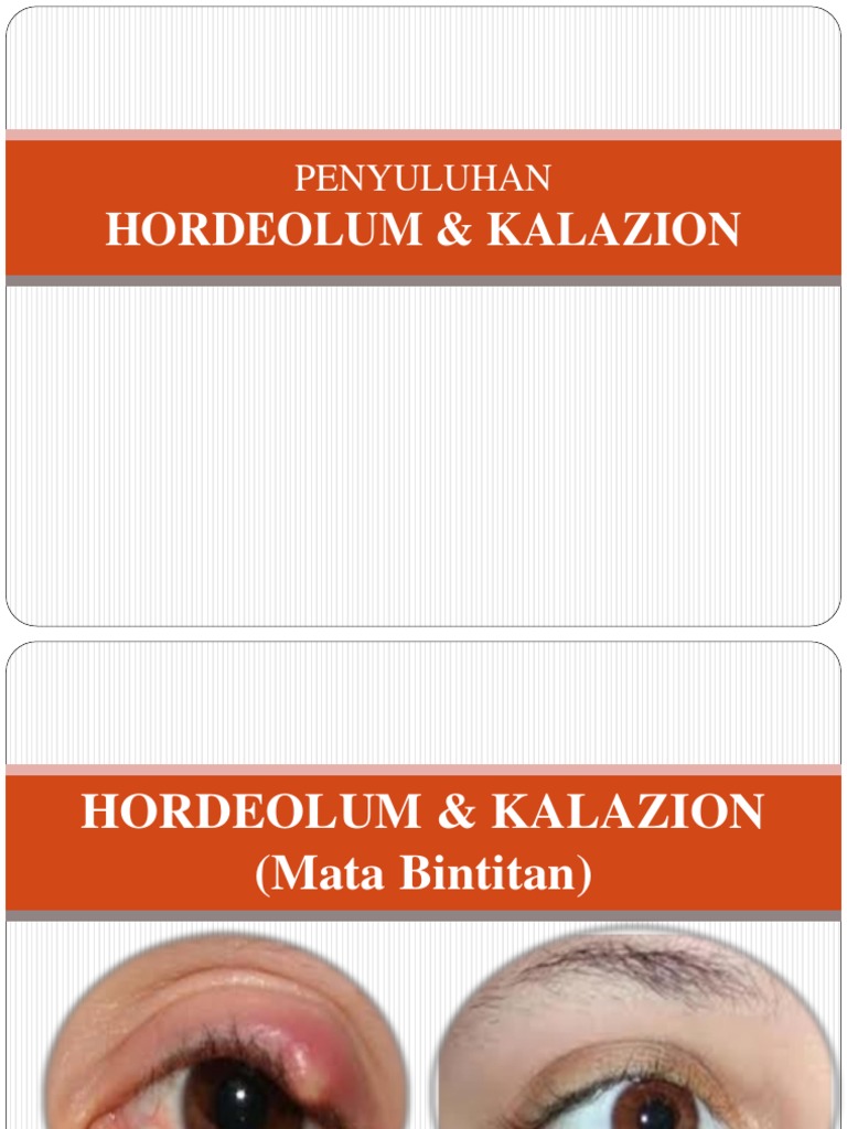 Hordeolum & Kalazion 2 | PDF