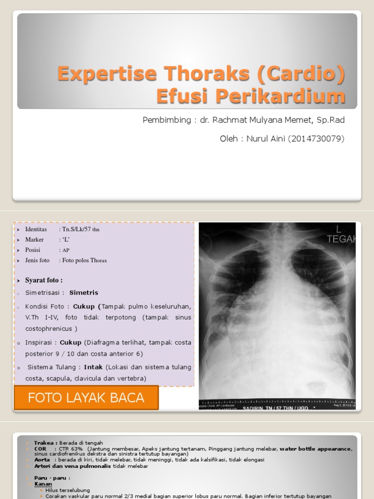 Efusi Perikardium - Aini | PDF