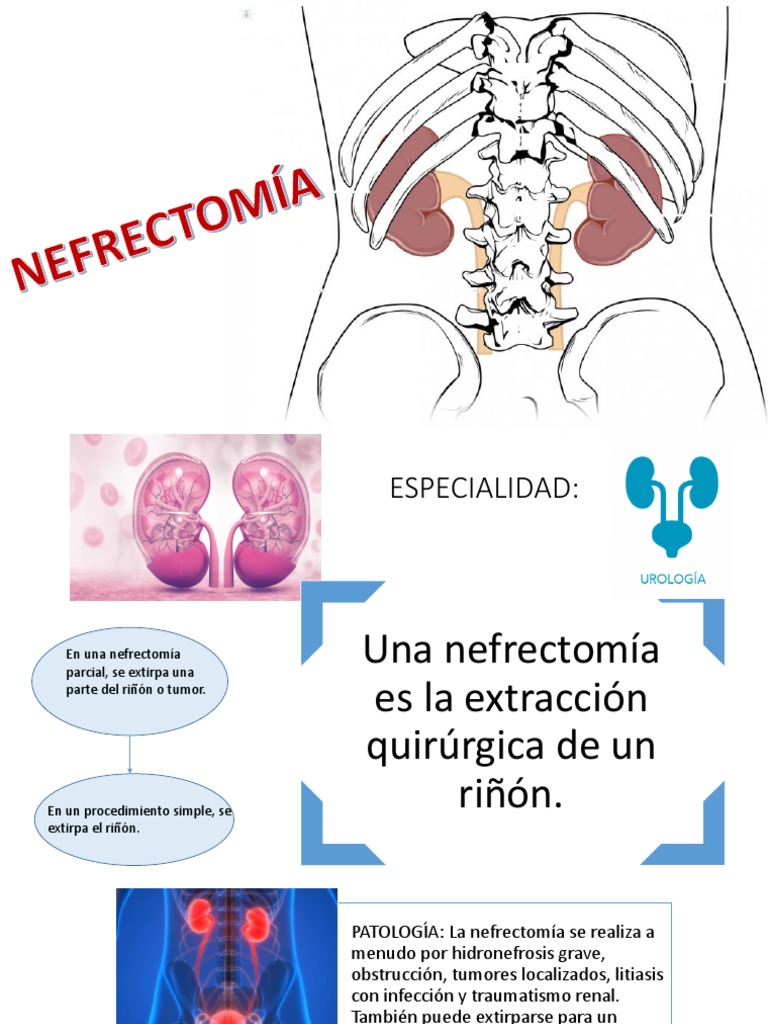 NEFRECTOMÍA | PDF | Riñón | Abdomen